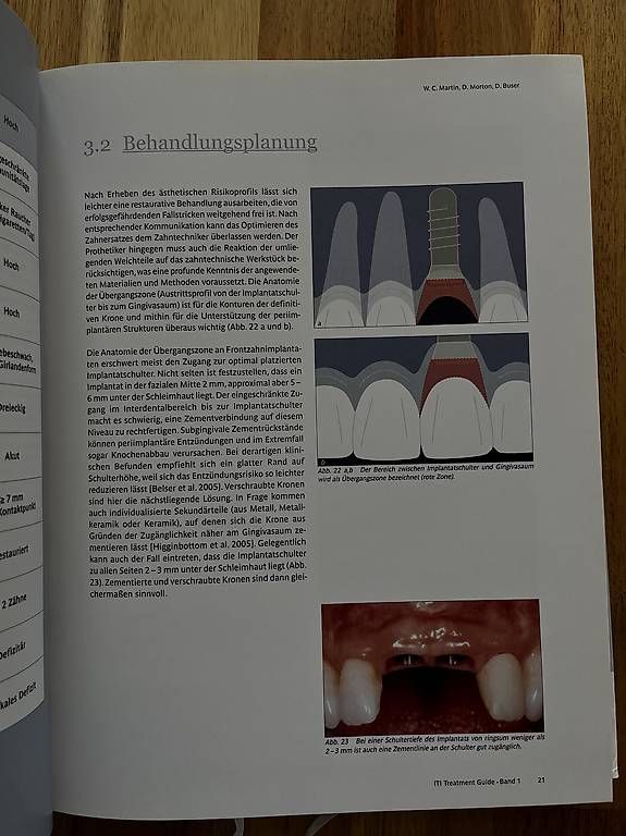 ITI Treatment Guide Band 1 Deutsch Ästhetische Therapie (Gebraucht) in ...